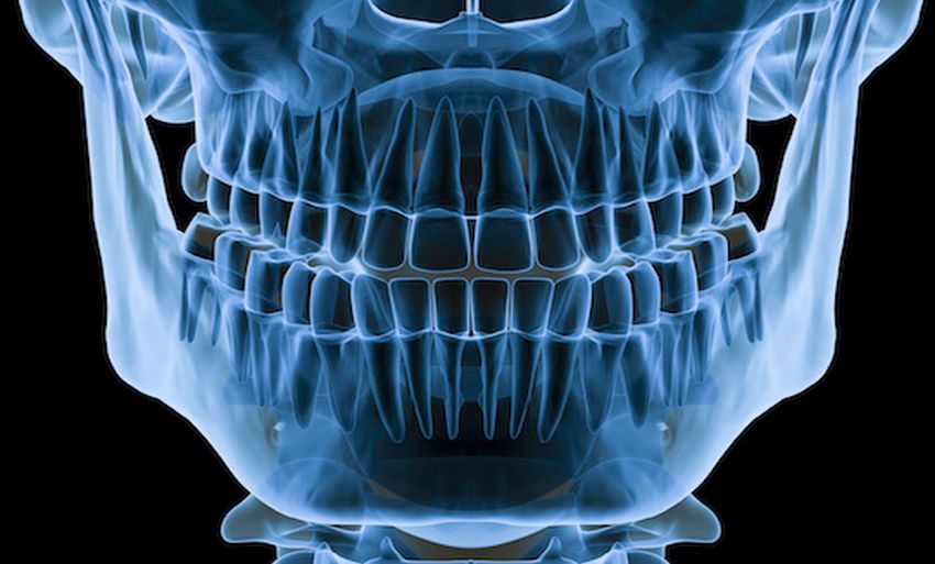 Fogászati röntgen - Fitline